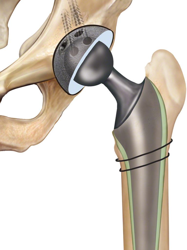 Revision Hip Replacement - Dr. Anthony Spriggins
