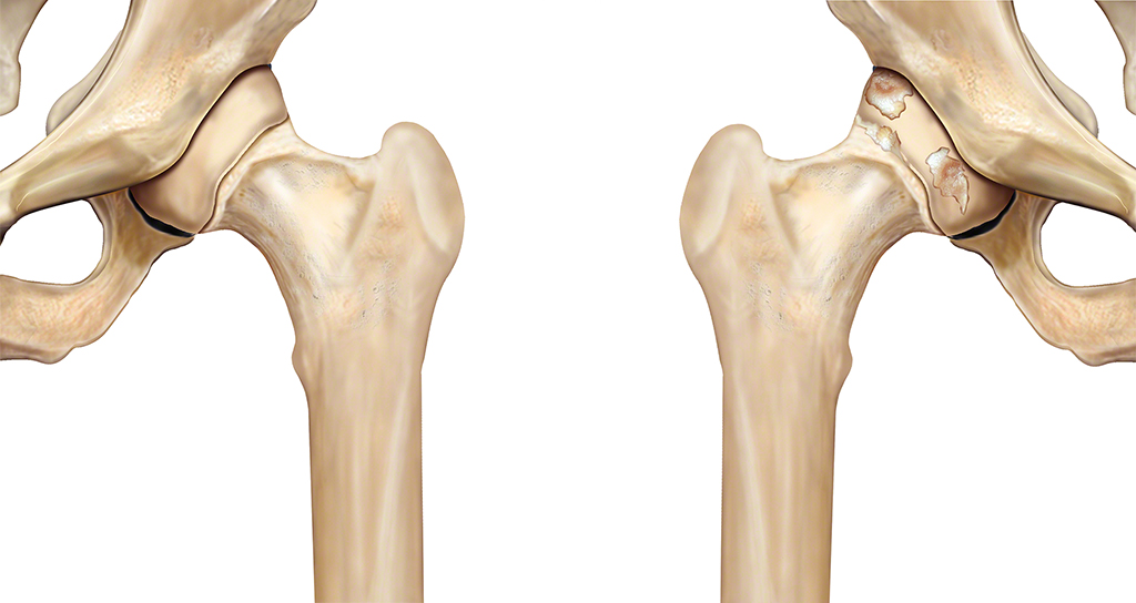 Total Hip Replacement - Dr. Anthony Spriggins