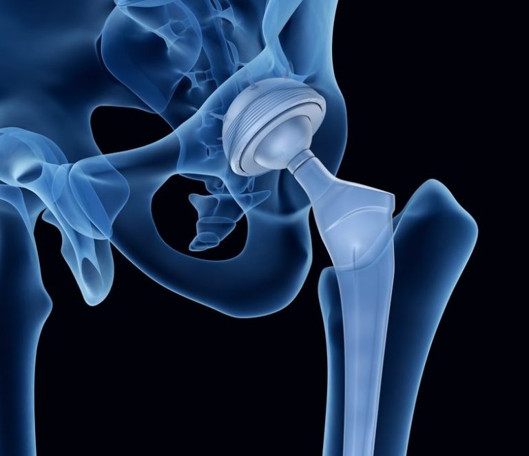 Dislocation following hip replacement surgery - Dr. Anthony Spriggins